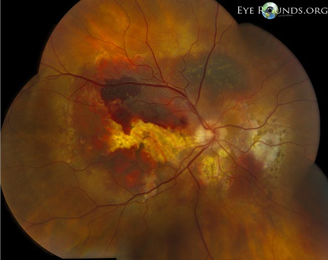 Polypoidal choroidal vasculopathy (PCV): The University of Iowa ...