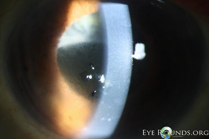 Pseudophakic Bullous Keratopathy : The University of Iowa, Ophthalmology