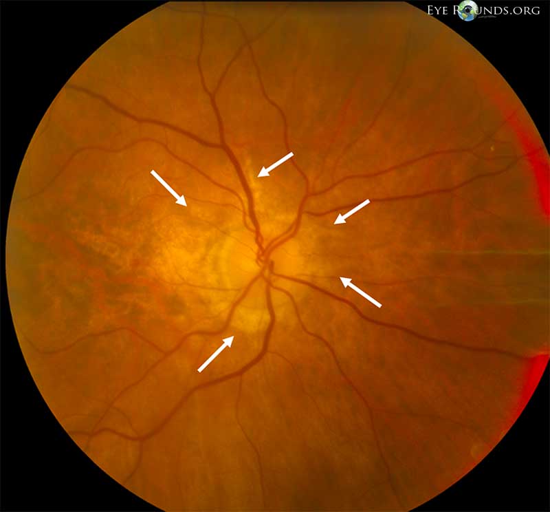 Pseudostreaks (Senile Atrophic Lines) :: The University of Iowa ...