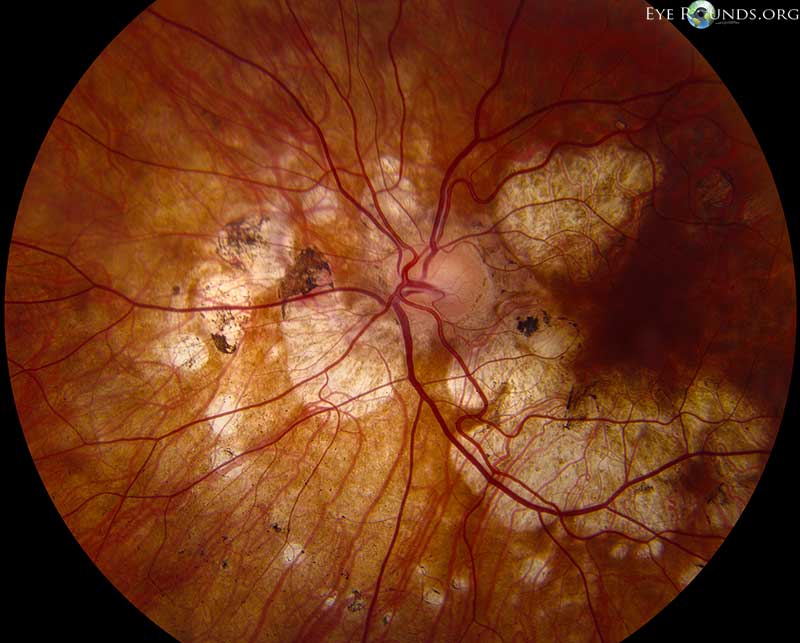 Serpiginous choroidopathy :: The University of Iowa, Ophthalmology