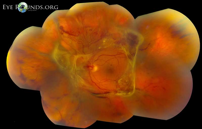 Traction retinal detachment :: The University of Iowa, Ophthalmology