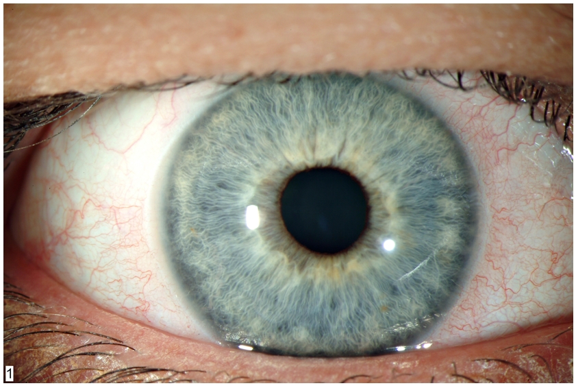 Ch. 1 Glaucoma: Optic Nerve Disease. A Patient's Guide to Glaucoma