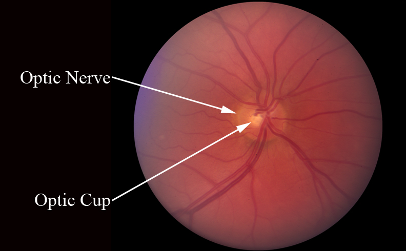 Ch. 1 Glaucoma: Optic Nerve Disease. A Patient's Guide to Glaucoma