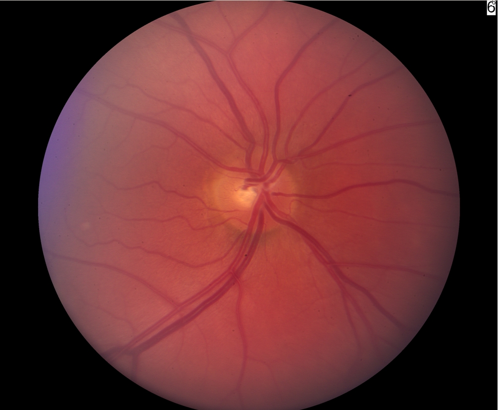 Ch 6 The Glaucoma Eye Examination And Diagnosis A Patient s Guide To 