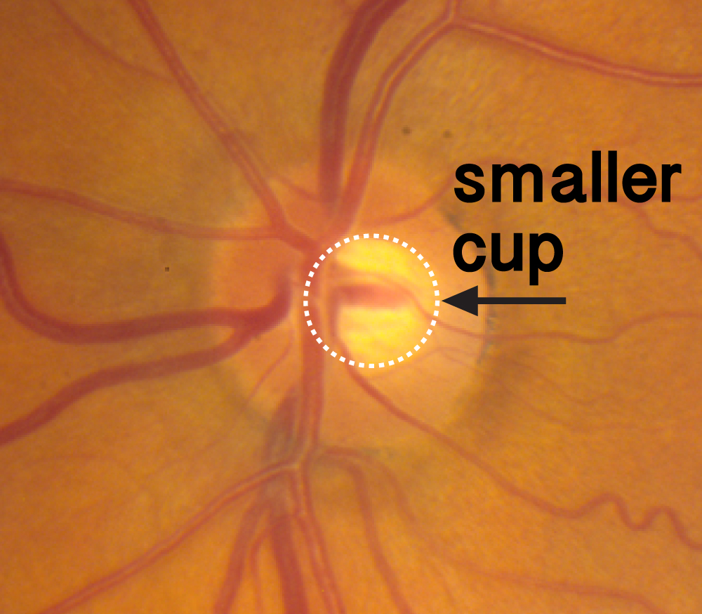 Ch. 1 Glaucoma: Optic Nerve Disease. A Patient's Guide to Glaucoma