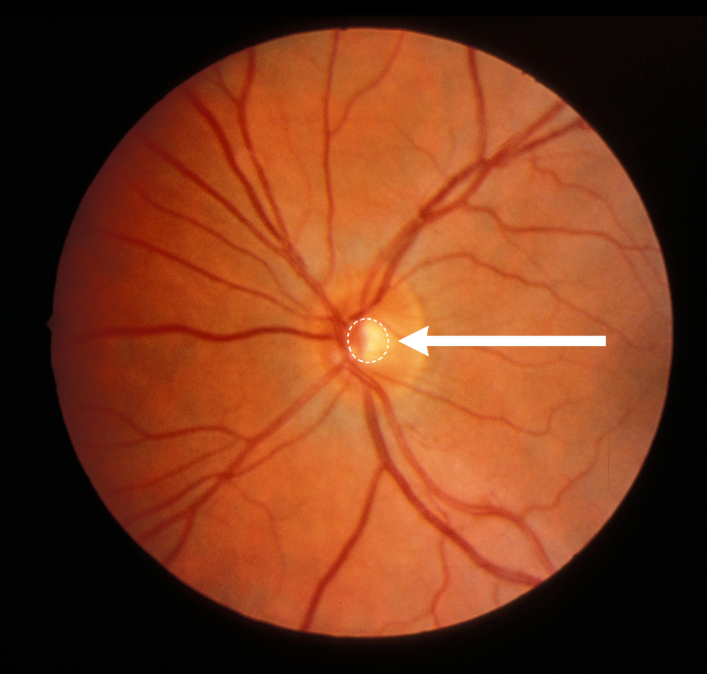 Ch 3 The Glaucoma Eye. A Patient's Guide to Glaucoma