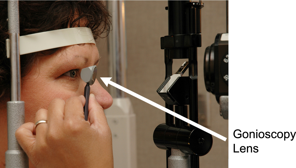 Ch 4 Types of Glaucoma. A Patient's Guide to Glaucoma