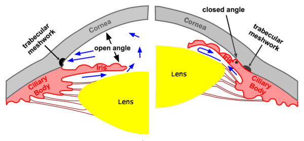 Ch 9. Glaucoma Emergency: Acute angle closure glaucoma. A Patient's ...