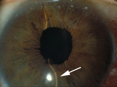 Ch 9. Glaucoma Emergency: Acute angle closure glaucoma. A Patient's ...