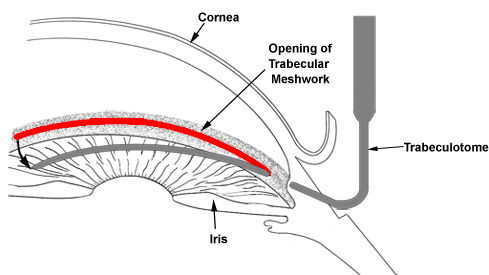 Ch 10 Pediatric Glaucoma. A Patient's Guide to Glaucoma