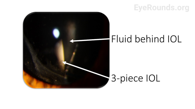 Capsular Block Syndrome