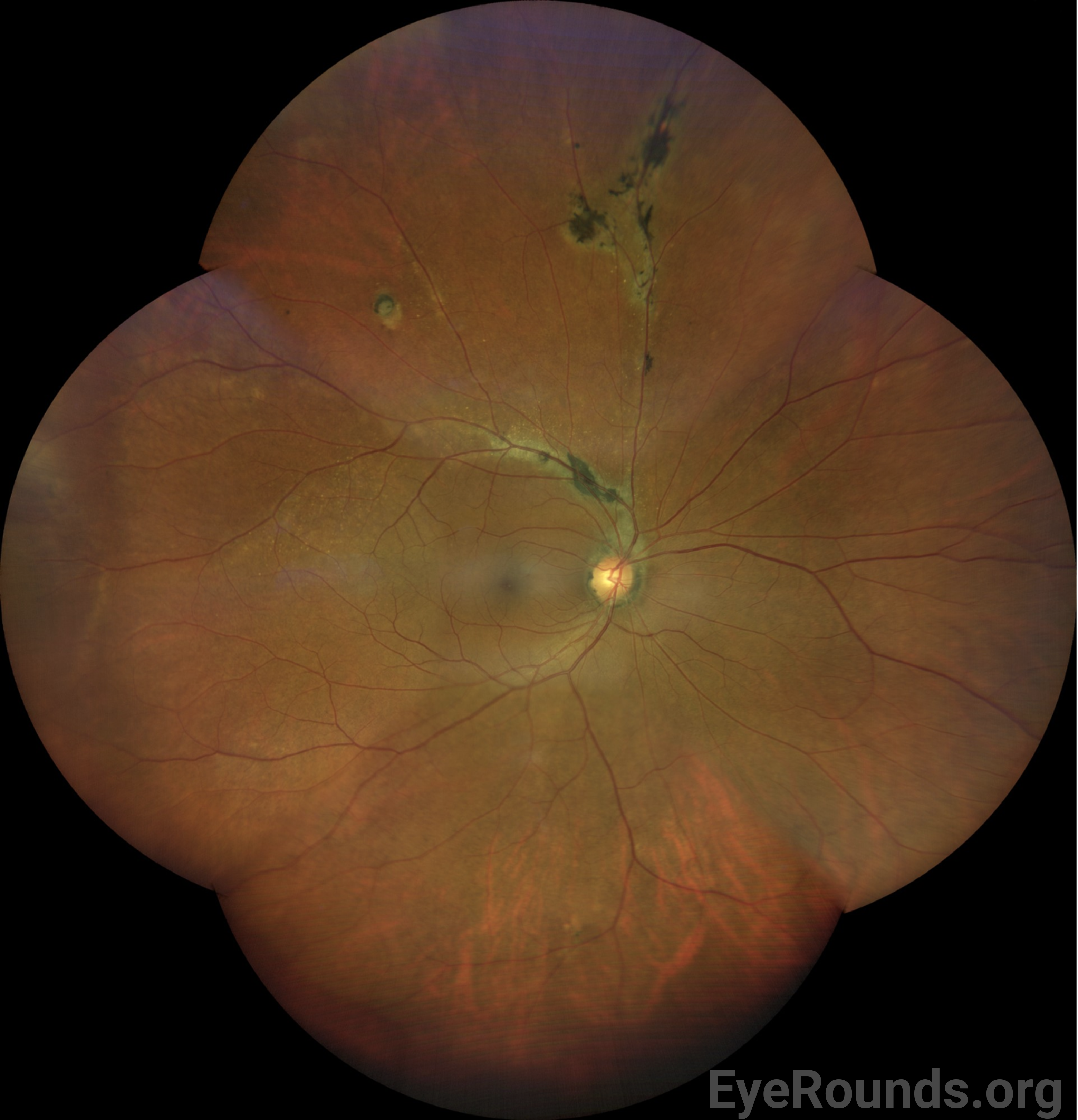 Pigmented Paravenous Retinochoroidal Atrophy
