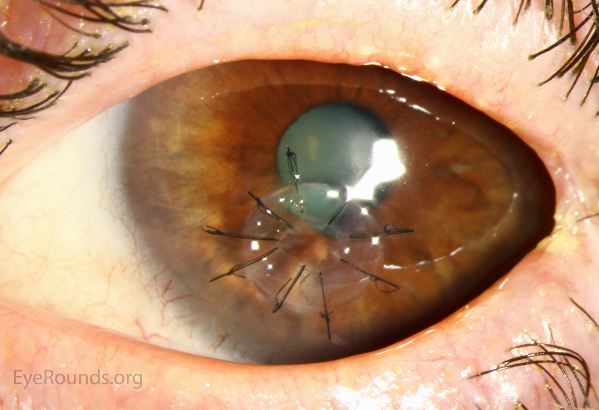 Penetrating Keratoplasty PK Penetrating Keratoplasty PK