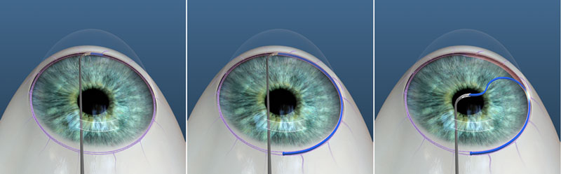 MIGS: Minimally Invasive Glaucoma Surgery