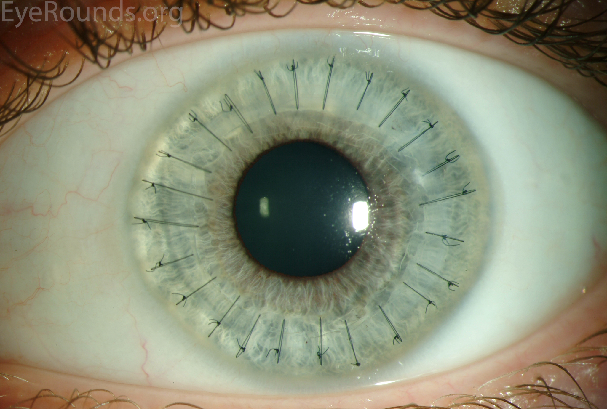 Penetrating Keratoplasty PK Penetrating Keratoplasty PK