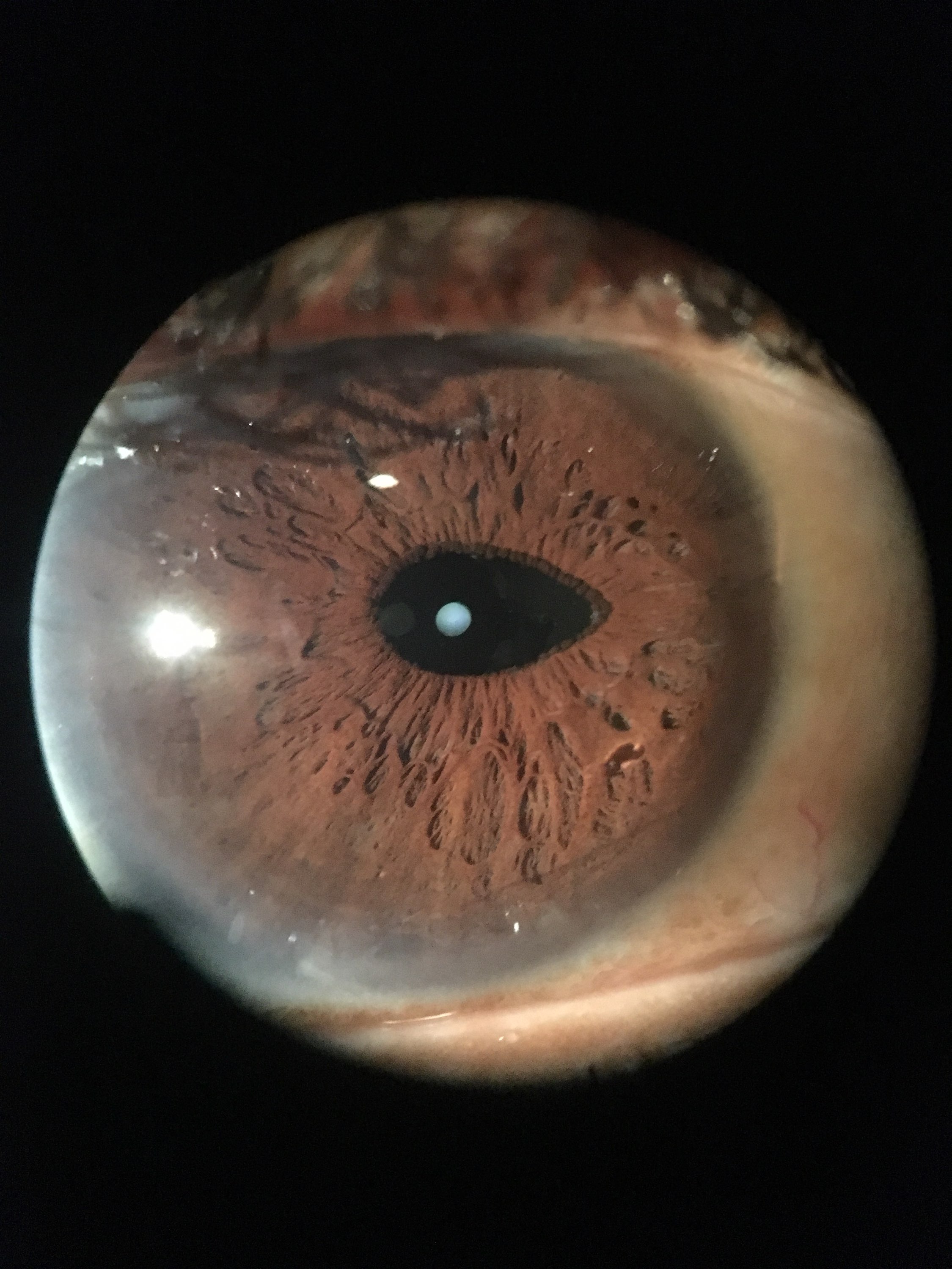 Malpositioned Hydrus Microstent