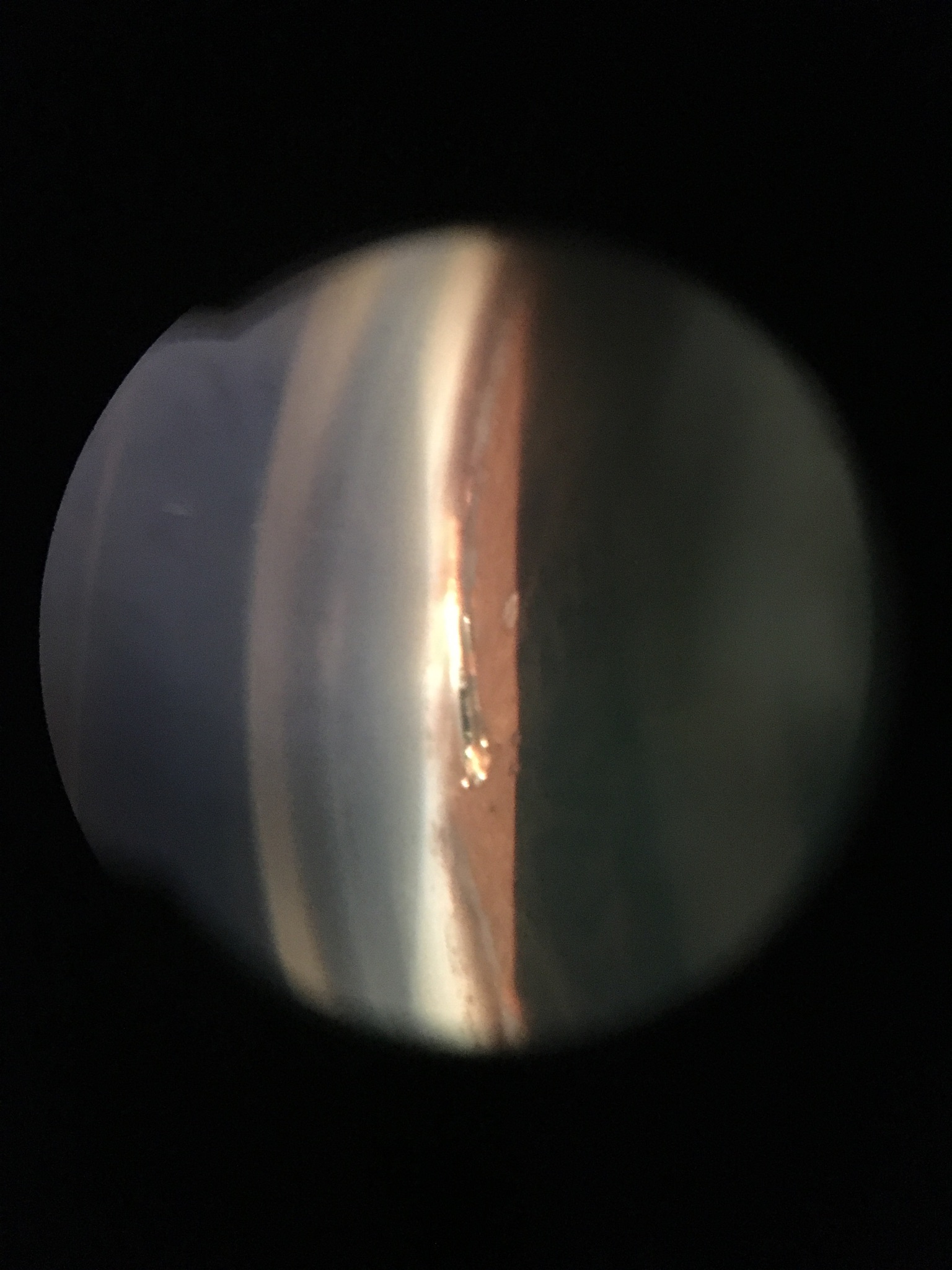 Malpositioned Hydrus Microstent