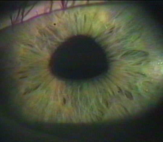 Adie's pupil. transillumination :: The University of Iowa, Ophthalmology